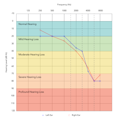 Levels of hearing loss | Degrees of hearing loss | THCP
