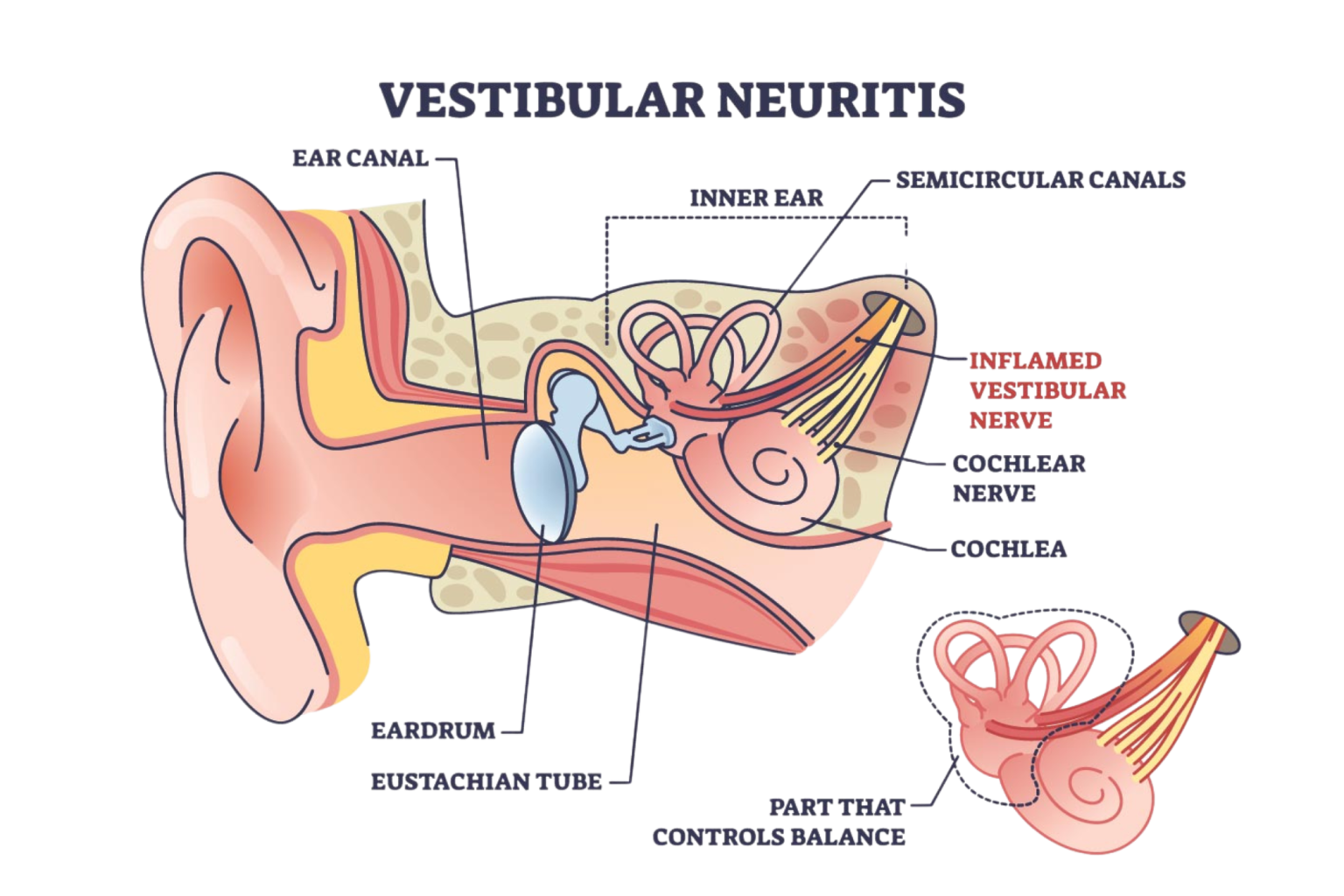 Vestibular Neuritis & Labyrinthitis | THCP
