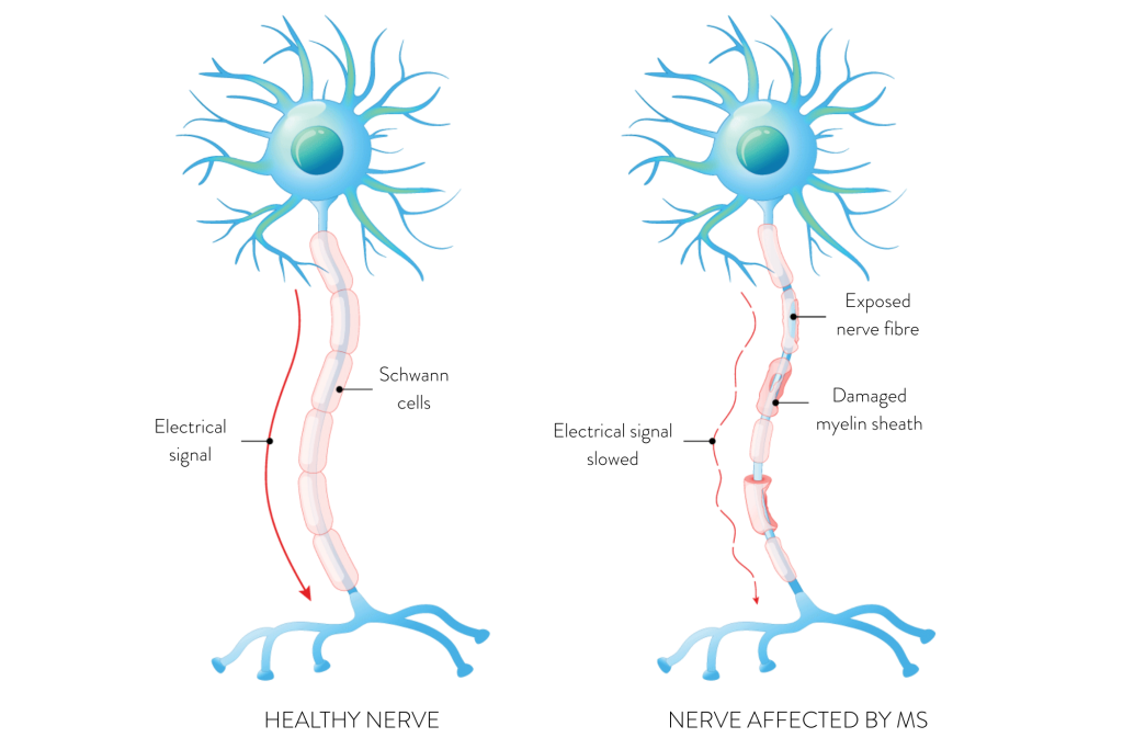 MS and Hearing Loss | THCP