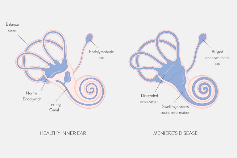 Meniere's disease: Symptoms and Treatment Options | THCP